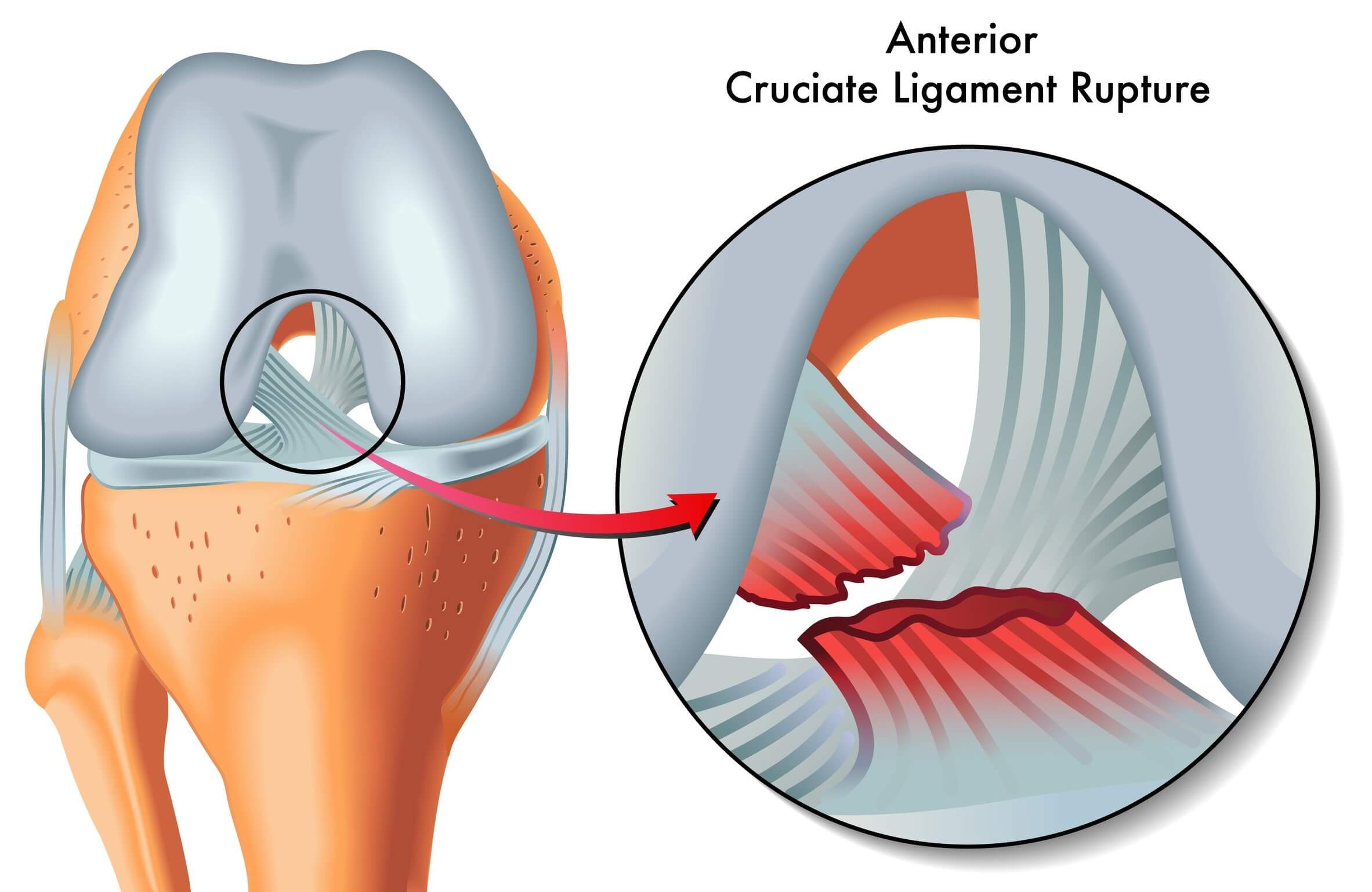 ACL Surgery | Arthroscopy Surgeons